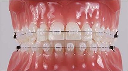 Adolescent Teen Braces