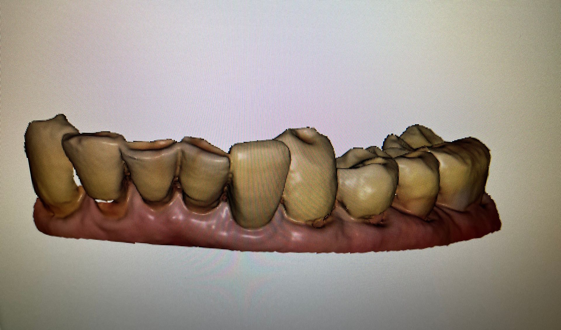 CEREC-Behandlungen | Zahnersatz | Ferradent