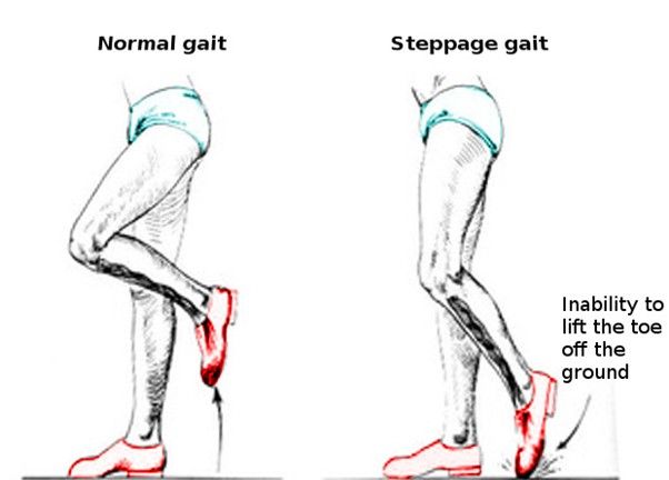 Steppage Gait: Causes, Treatment & Rehab Options | Just Walk