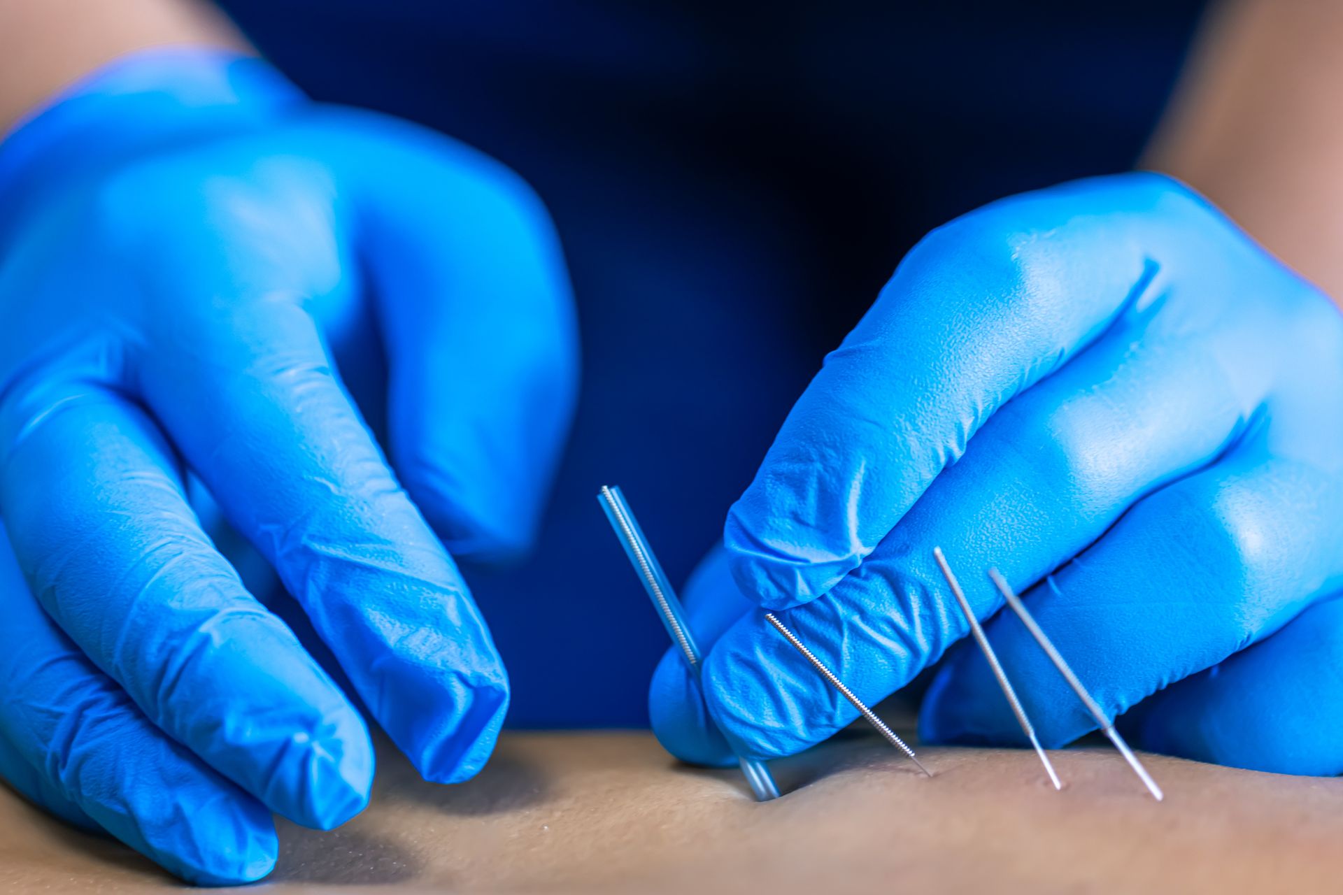 Dry Needling Treatments Charlotte, NC - Greenapple Sports