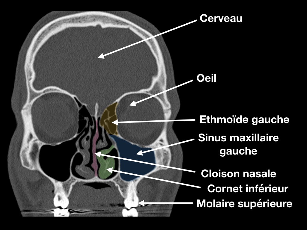 Ethmoïdectomie : opération de la sinusite | Docteur Nicolas Fontaine
