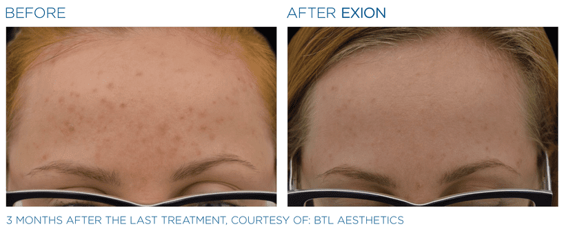 EXION® Clear RF | Dr. Gray's Aesthetics | Orlando, FL.