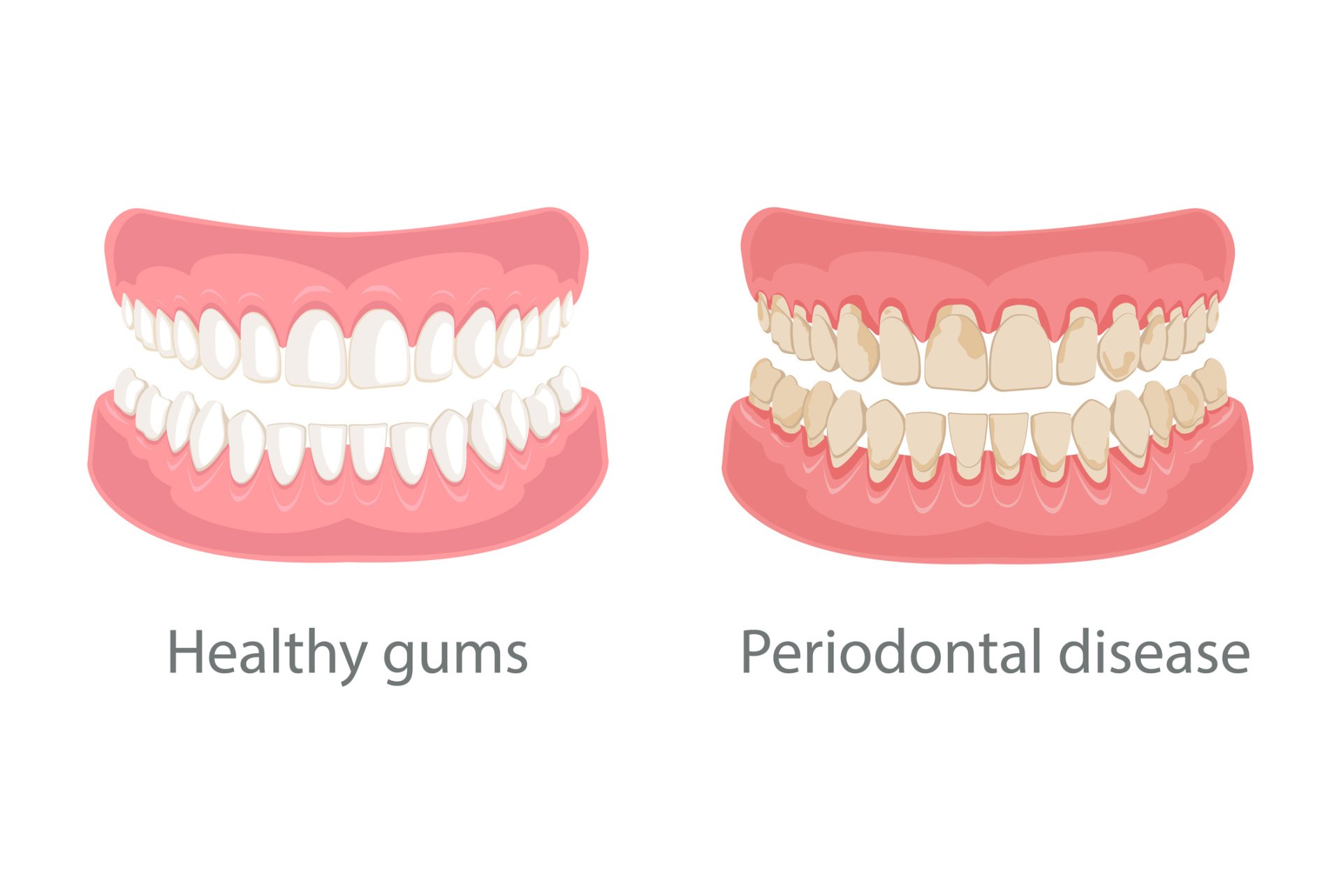 Periodontal Treatments | Gregory Peterson, DMD & Associates