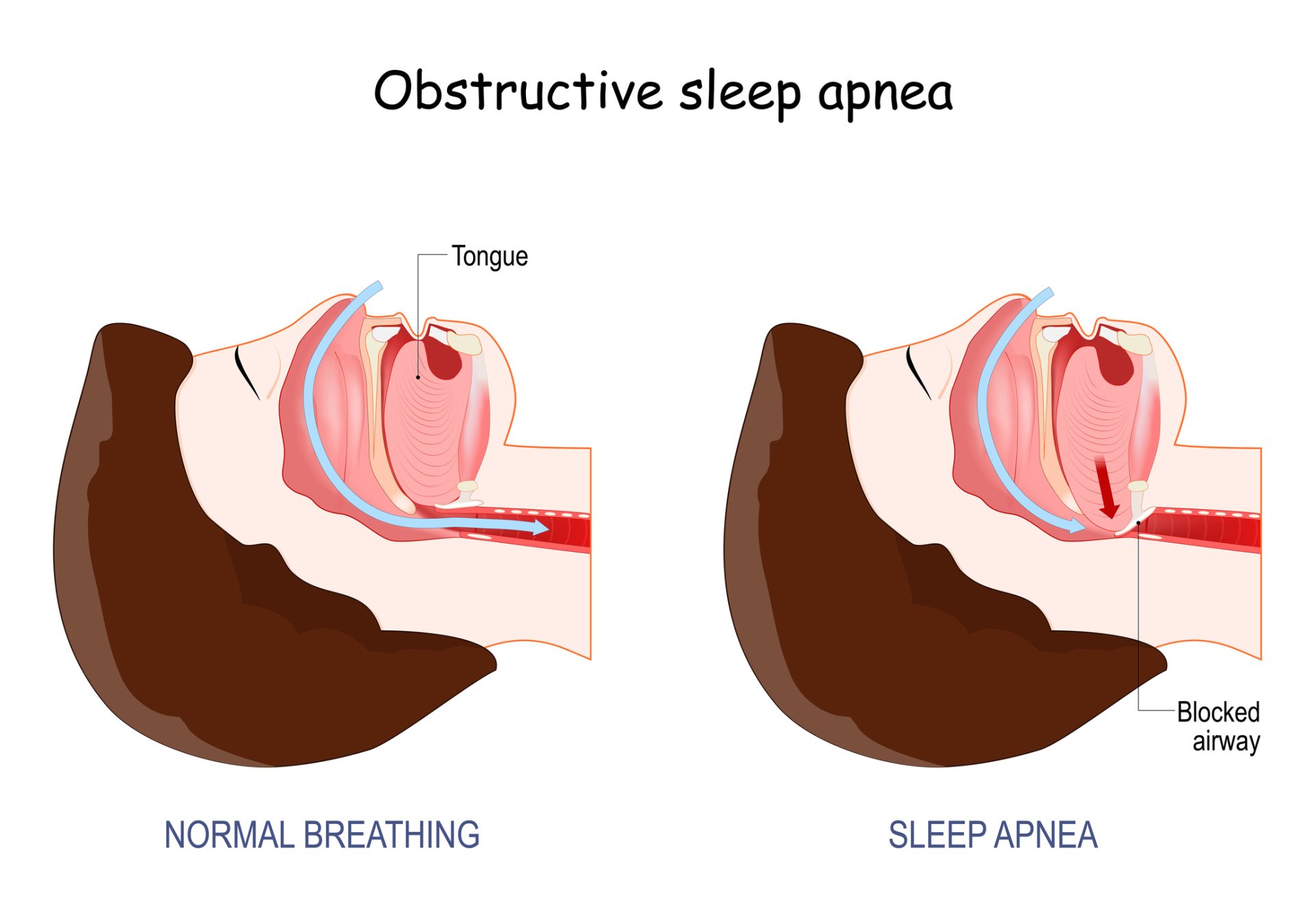 Obstructive Sleep Apnea (OSA) | Gregory Peterson, DMD & Associates