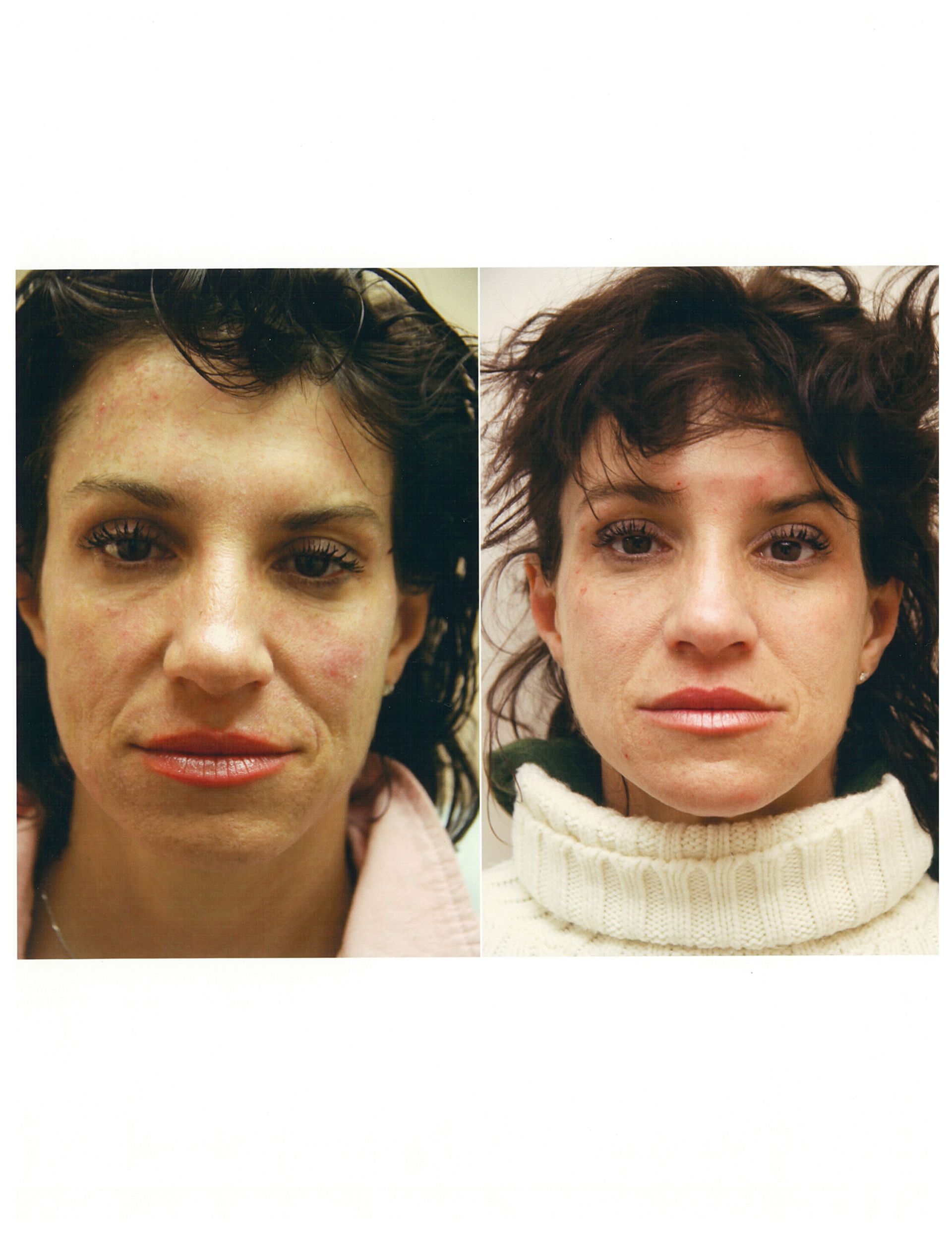 Face & Eye Rejuvenation Surgery | Scott Wells MD | New York, NY & Palm ...
