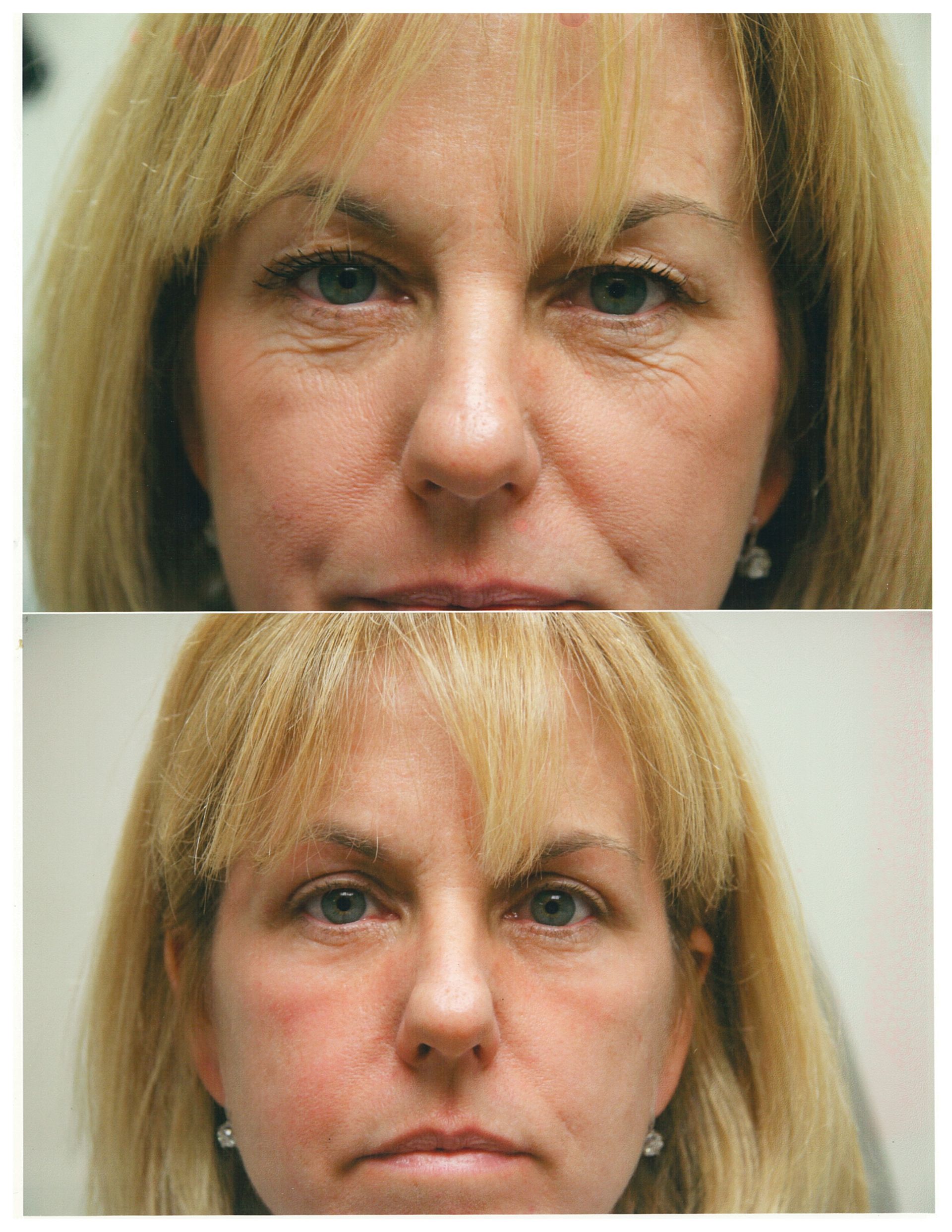 Face & Eye Rejuvenation Surgery | Scott Wells MD | New York, NY & Palm ...