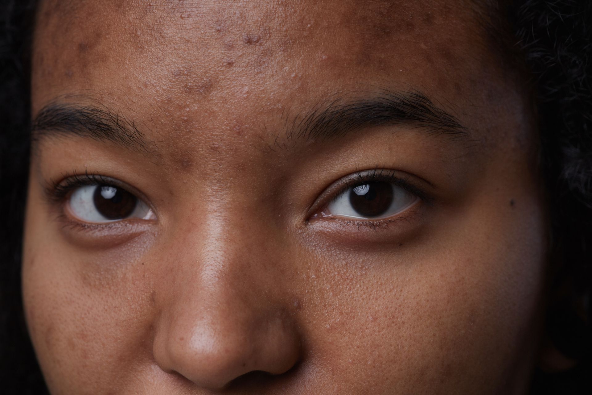 Acne Scars | Legacy Dermatology - Algonquin, IL
