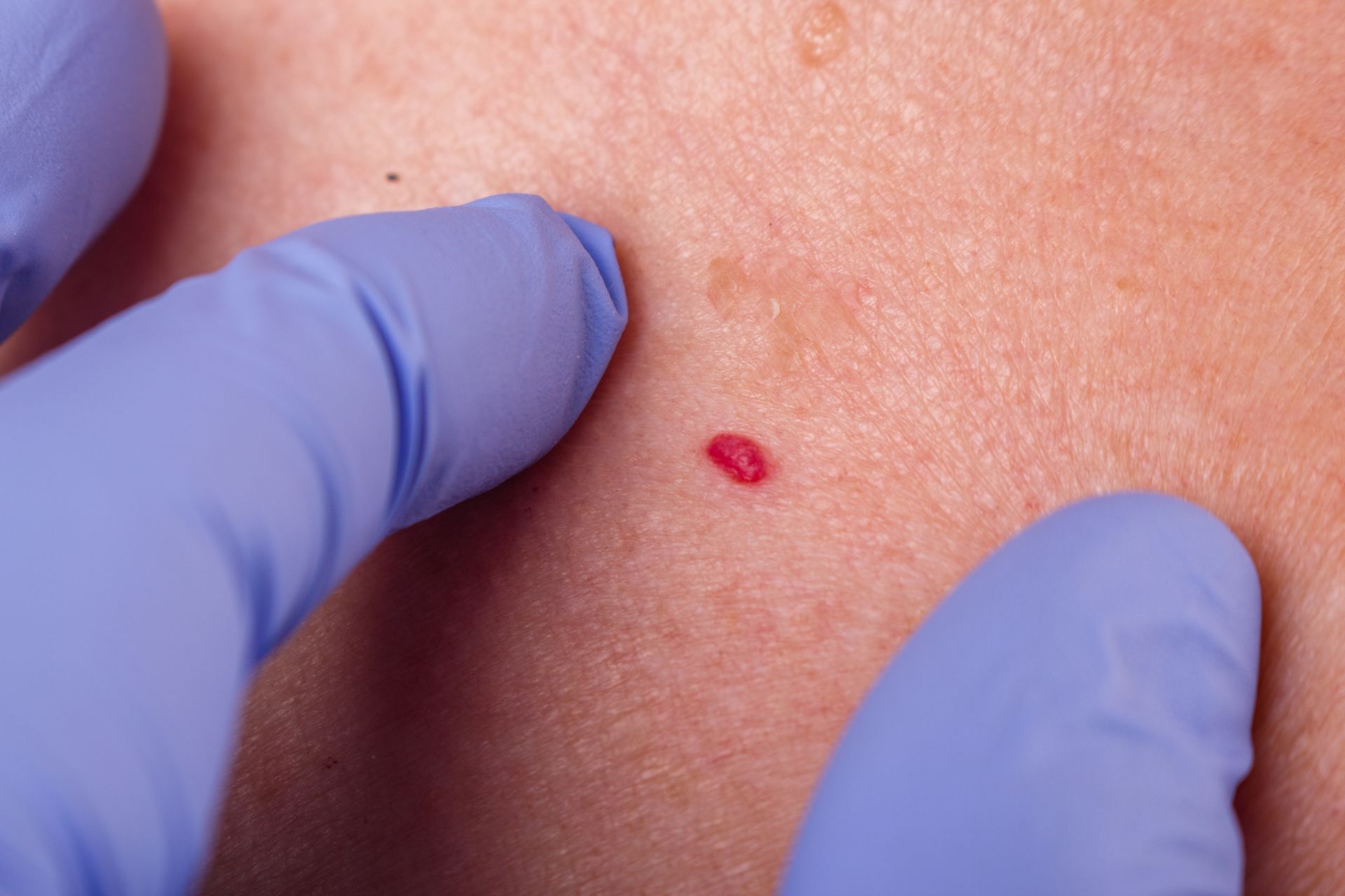 Vascular Lesions & Angioma | Legacy Dermatology - Algonquin, IL