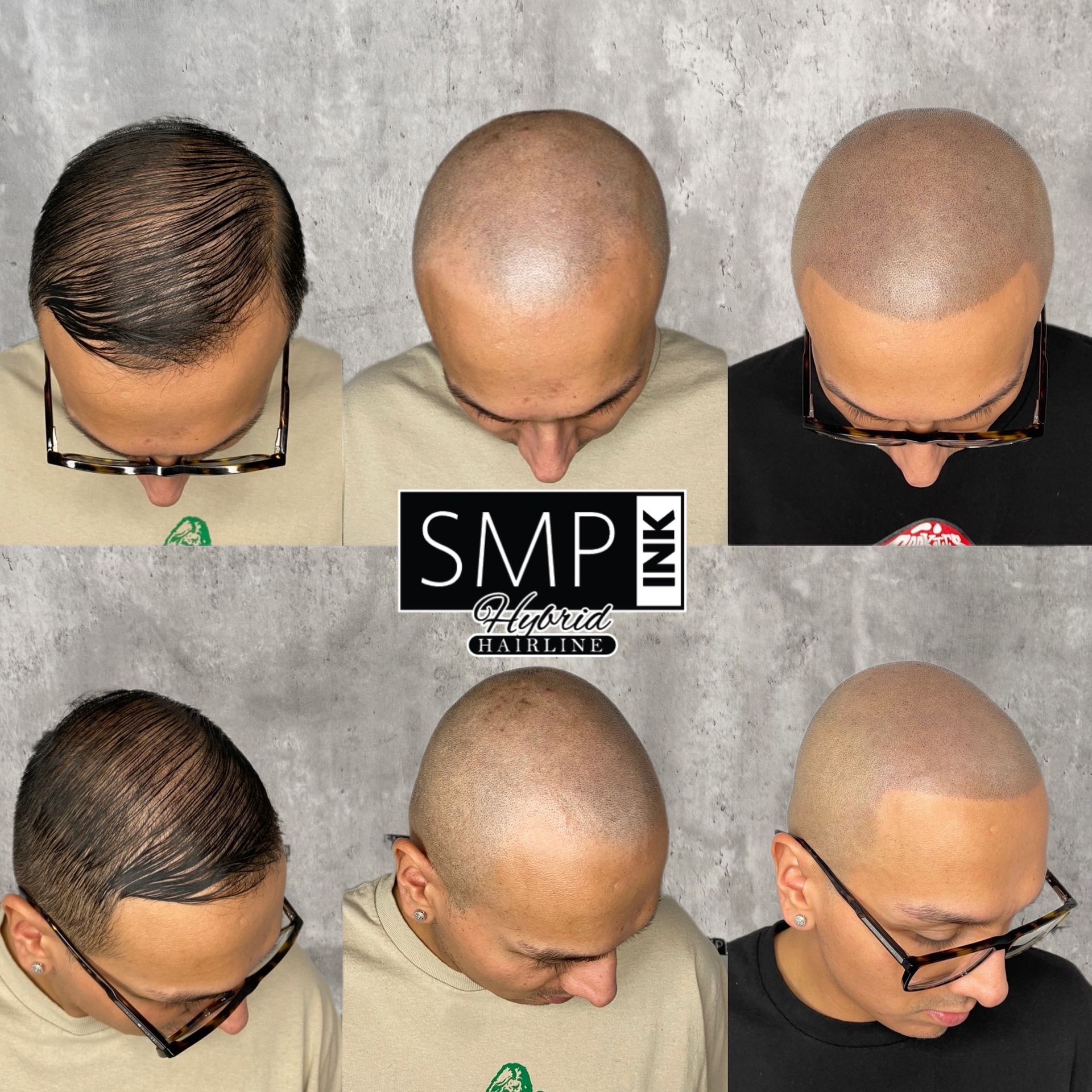 Scalp Micropigmentation for Men | SMP INK | Las Vegas