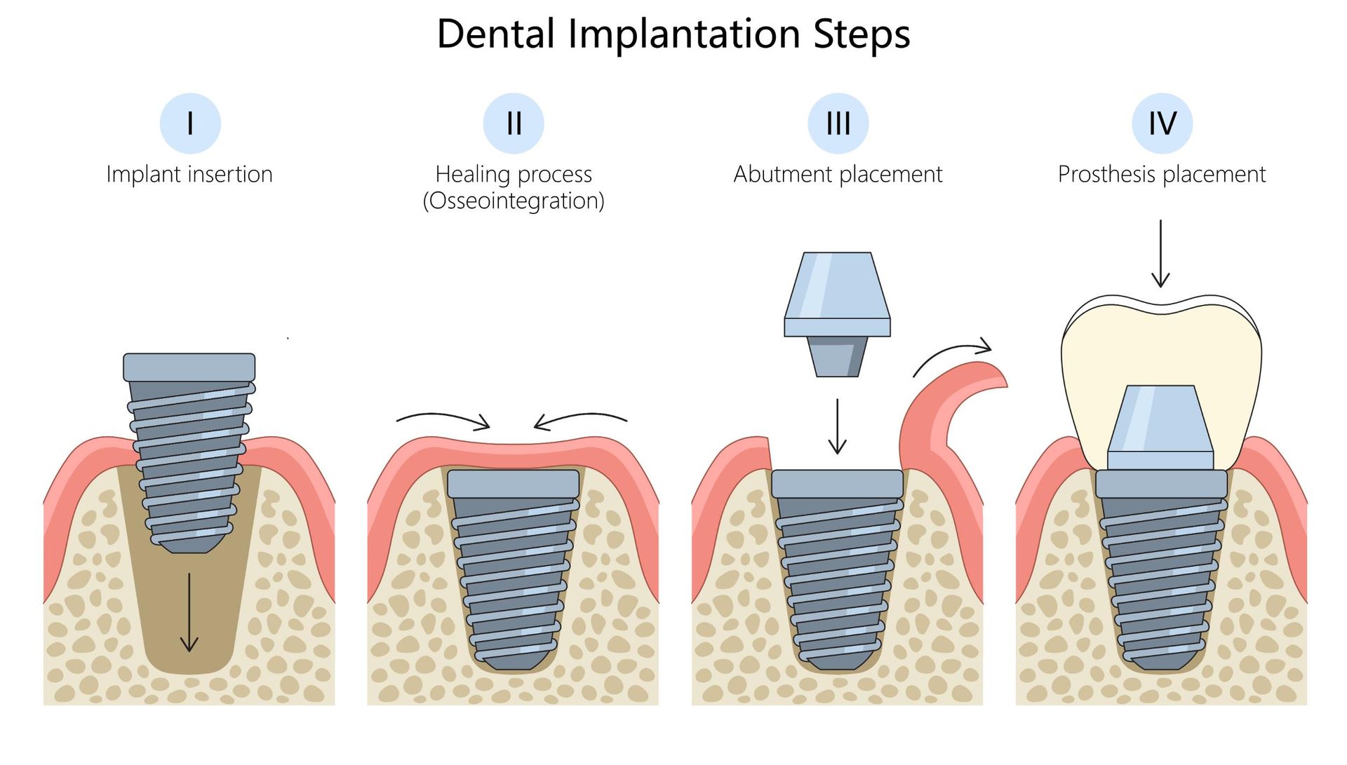 Screw Teeth in Implants: Procedure, Benefits & Costs