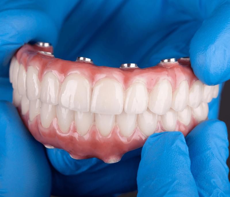 Screw Teeth in Implants: Procedure, Benefits & Costs