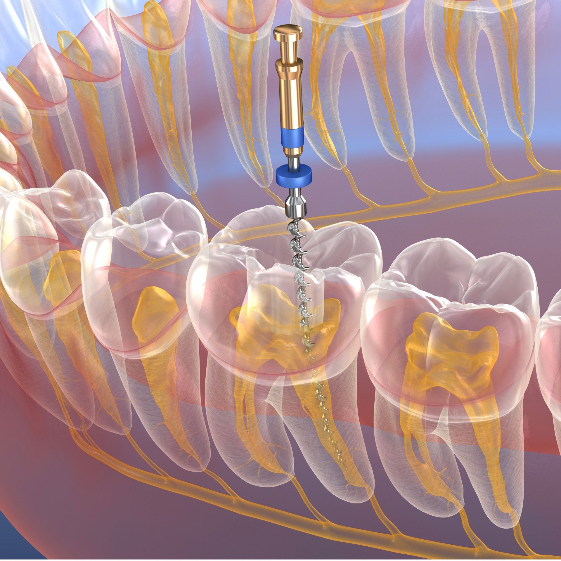 Root Canal Treatments with IV Sedation - Endothetics Endodontics