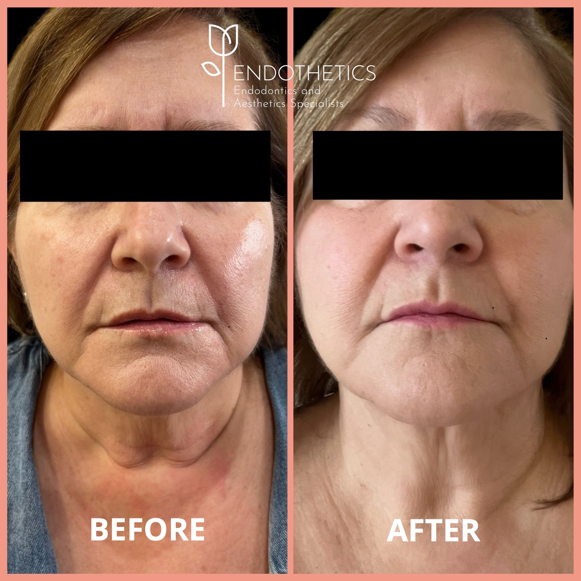 Chin Liposuction & Double Chin Removal | Dr. Acevedo Tampa & Brandon FL