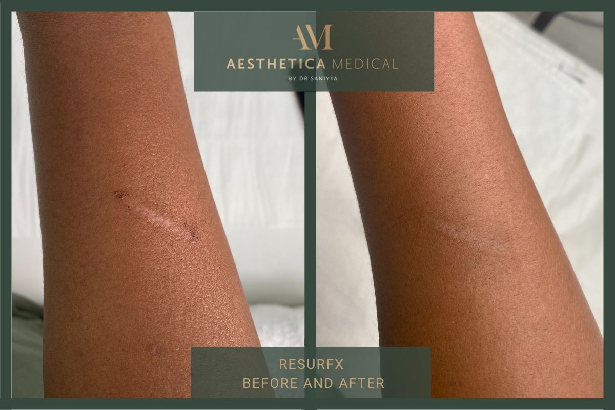 ResurFX before and after pictures at Aesthetica Medical