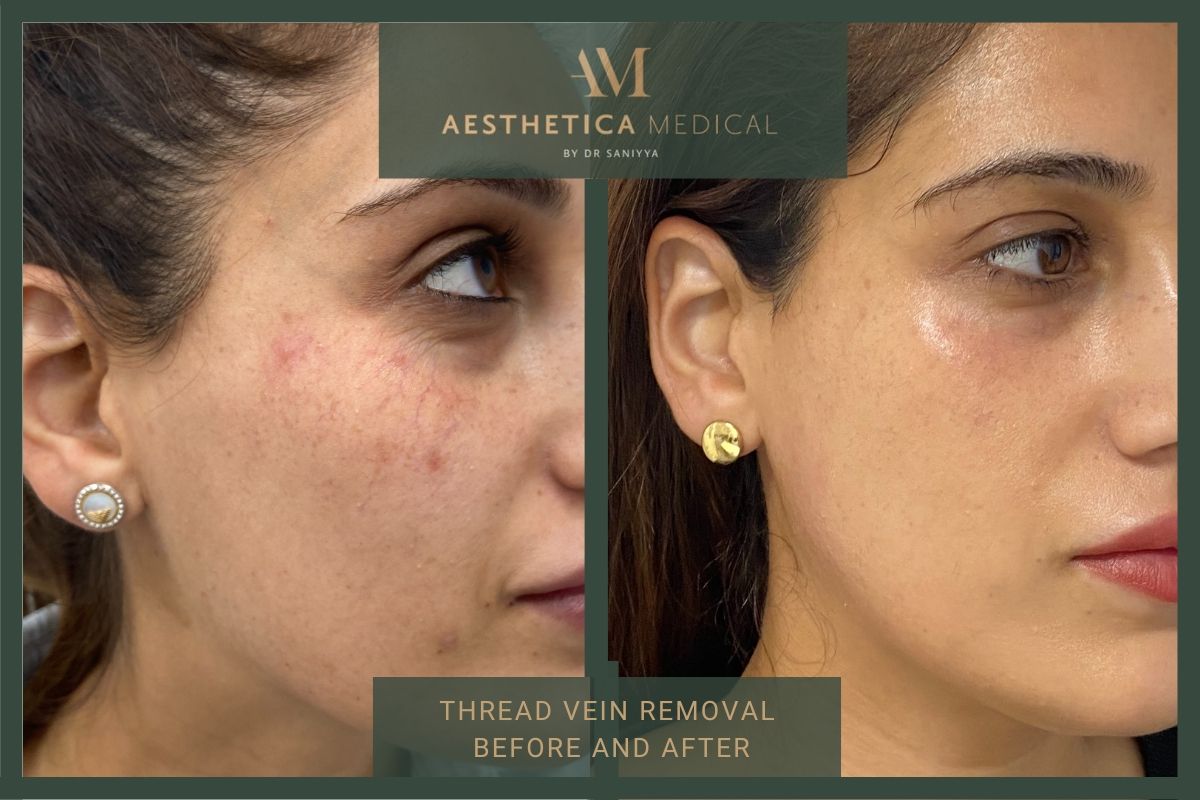 Thread Vein Removal: Before & After Photos | Aesthetica Medical