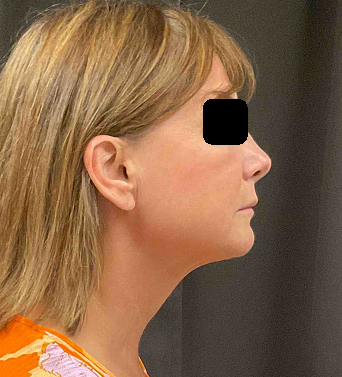 Renuvion Face & Neck and Tight Before & After Photos | William Wallace ...