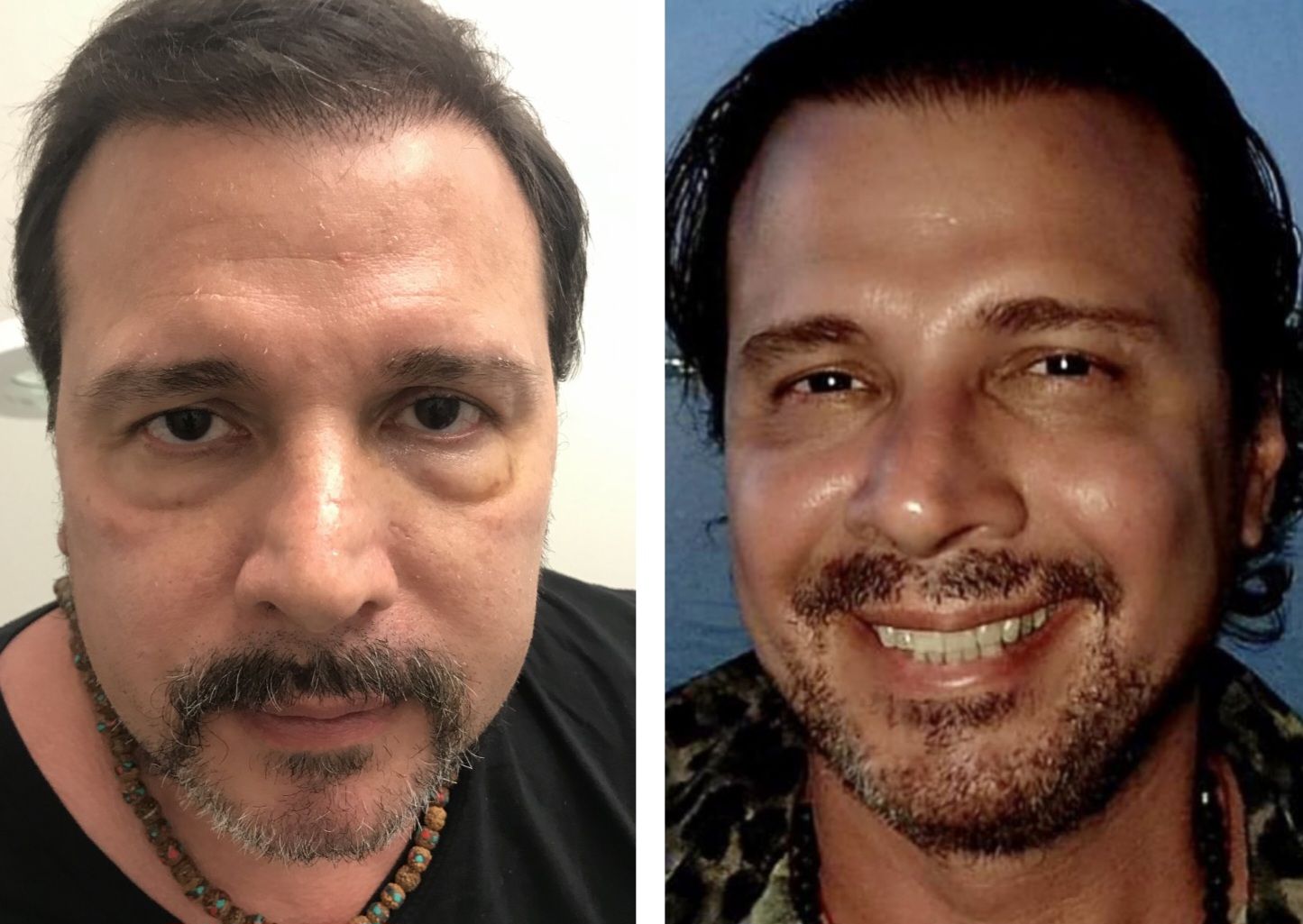 Brotox, Botox for Men in Midtown Miami, FL | Monaco MedSpa