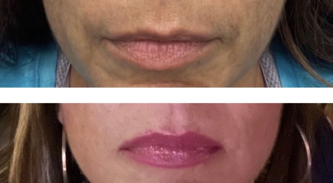 Monaco MedSpa Before and After Gallery, Real Clients, Real Results