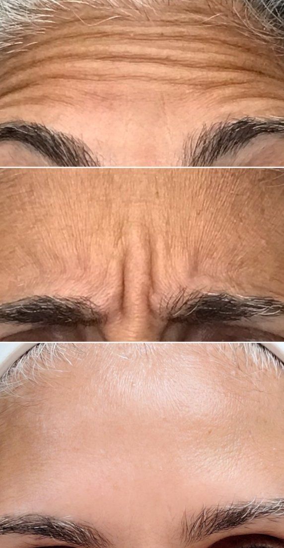 Monaco MedSpa Before and After Gallery, Real Clients, Real Results