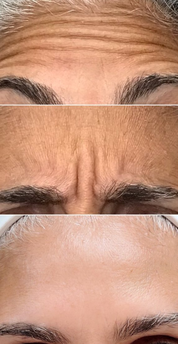 Monaco MedSpa Before and After Gallery, Real Clients, Real Results