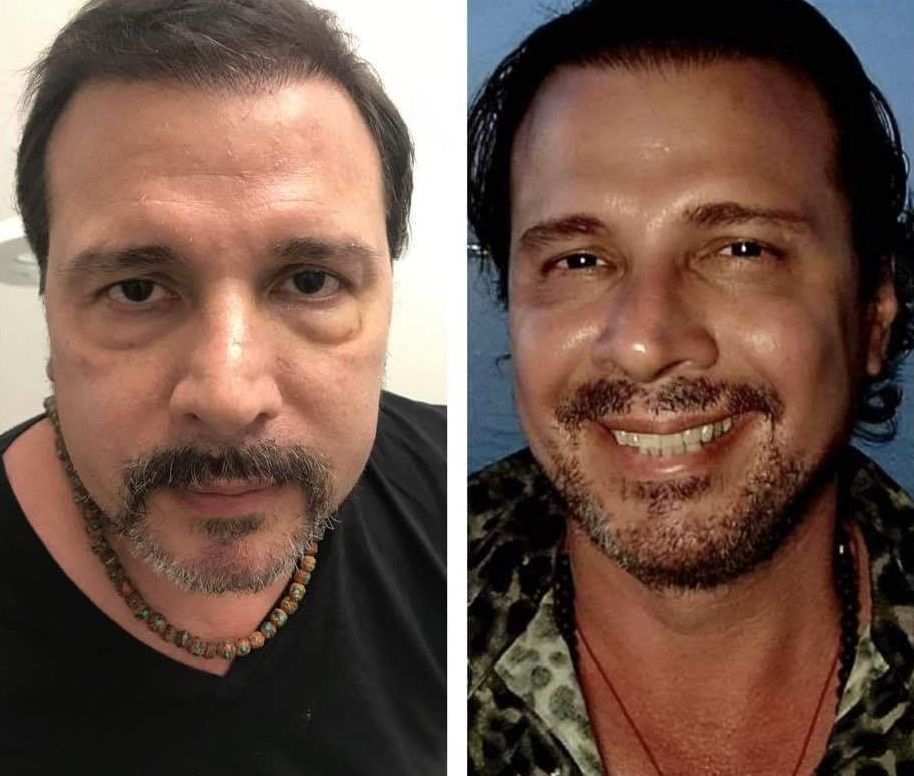 Monaco MedSpa Before and After Gallery, Real Clients, Real Results