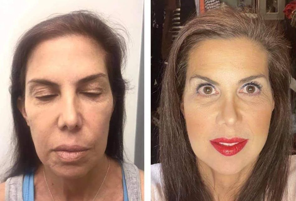 Monaco MedSpa Before and After Gallery, Real Clients, Real Results