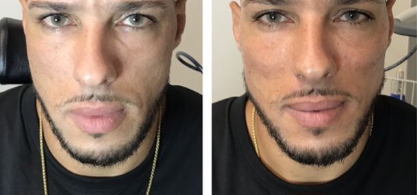 8 Point Vertical Facelift in Midtown Miami, FL | Monaco MedSpa