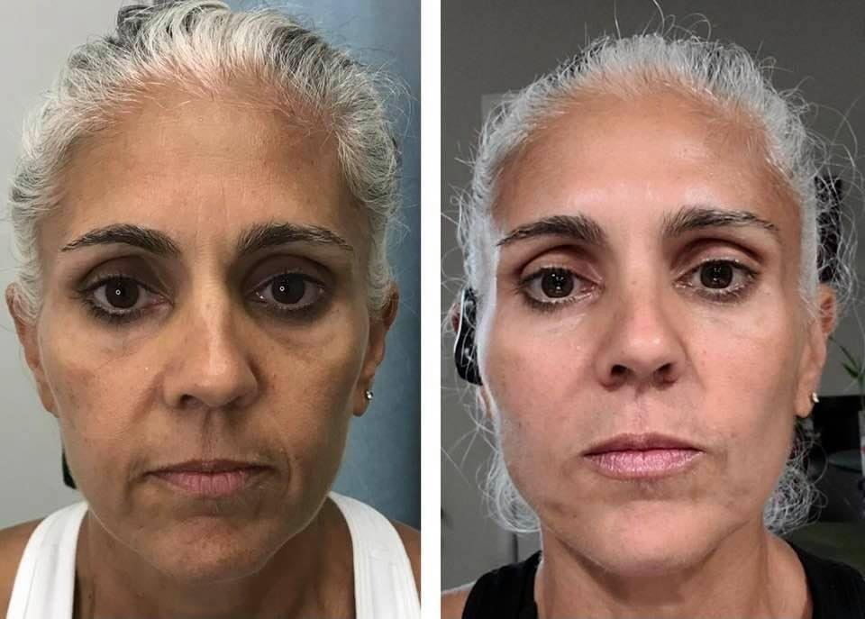 Monaco MedSpa Before and After Gallery, Real Clients, Real Results