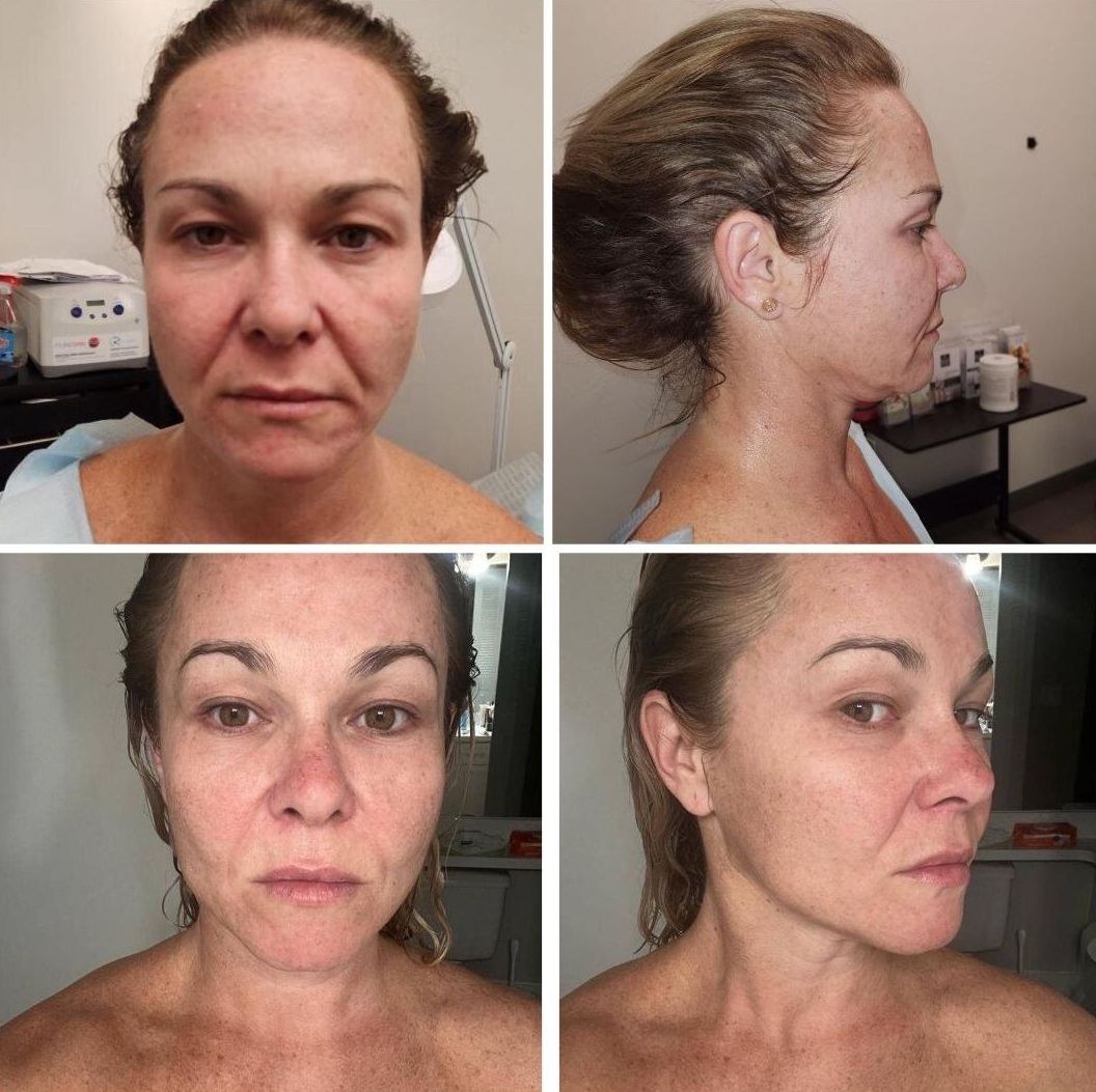 Monaco MedSpa Before and After Gallery, Real Clients, Real Results