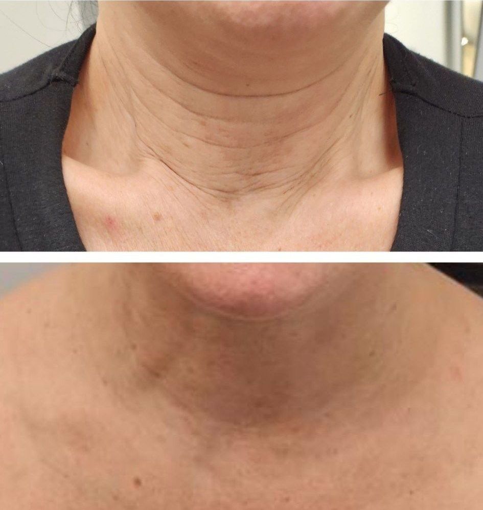 Monaco MedSpa Before and After Gallery, Real Clients, Real Results