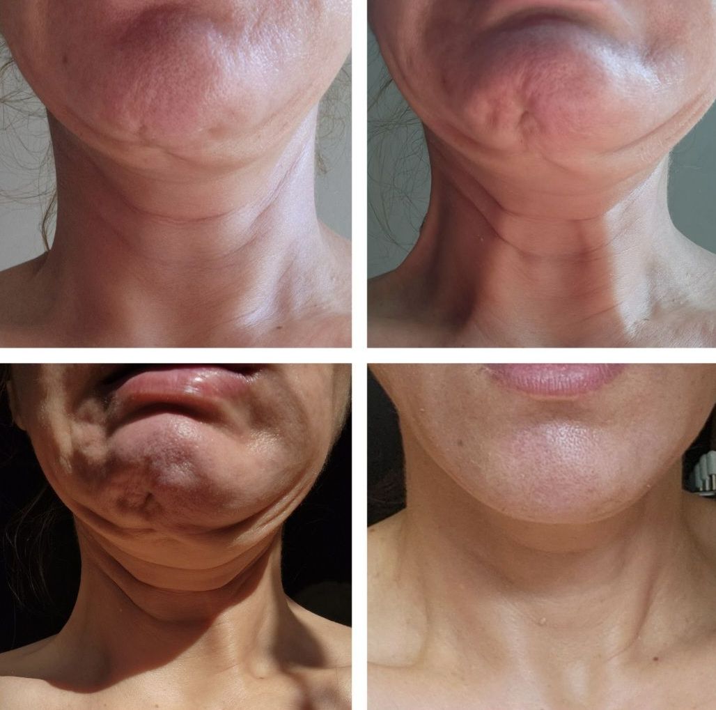 Dermal Fillers in Miami, FL | Monaco MedSpa