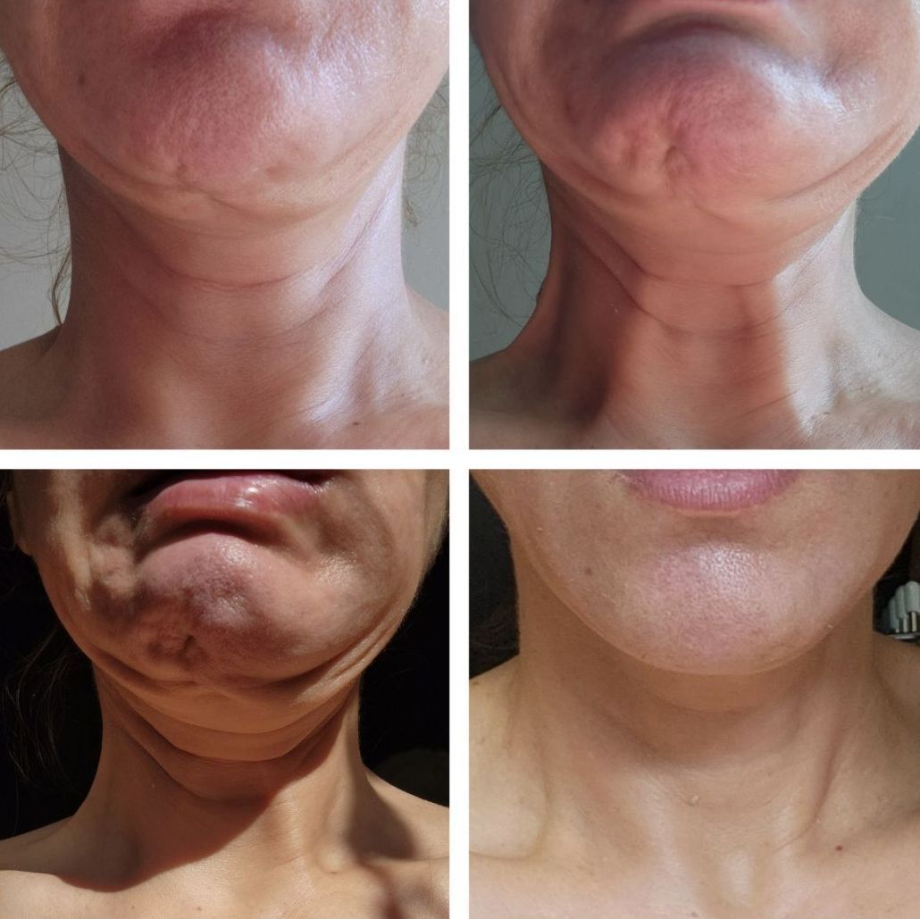 Neuromodulator, Botox, Dysport in Miami, FL | Monaco MedSpa