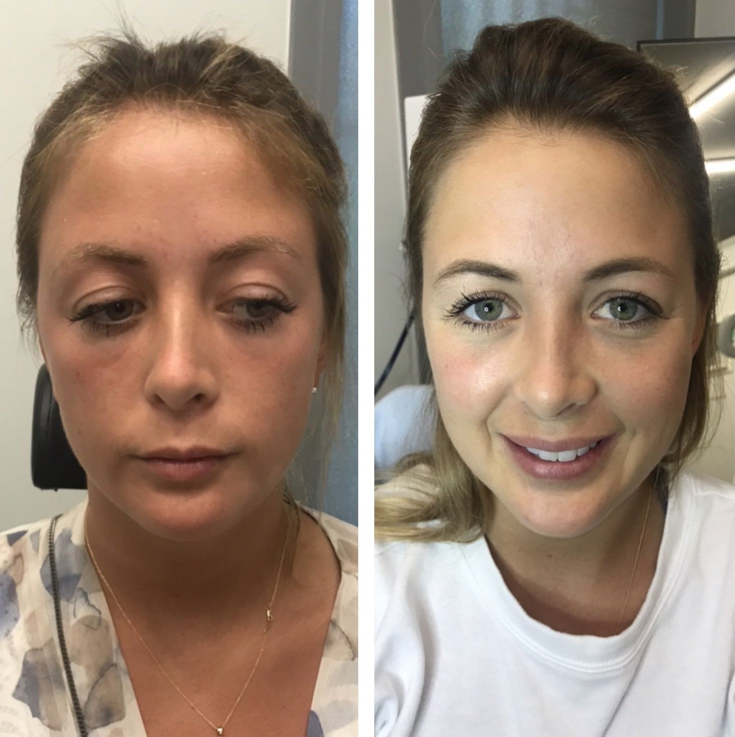 Dermal Fillers in Miami, FL | Monaco MedSpa