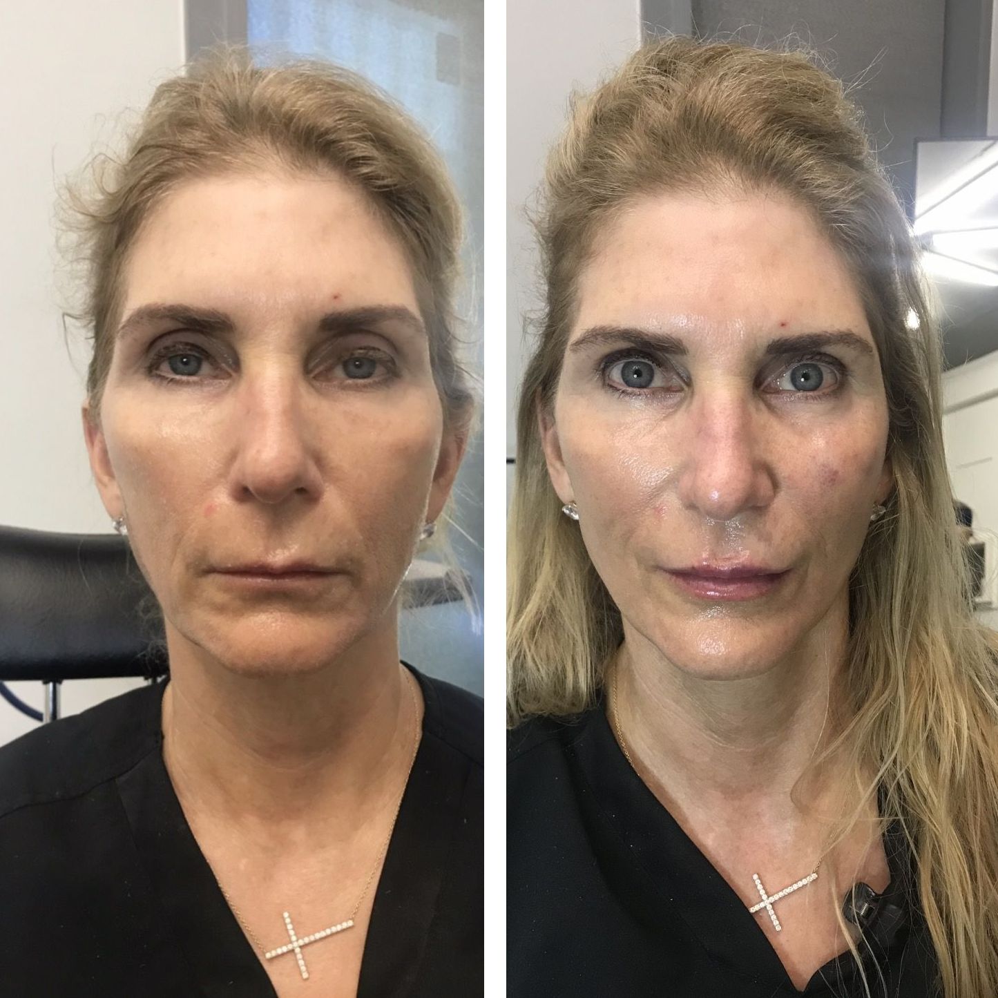 8 Point Vertical Facelift in Midtown Miami, FL | Monaco MedSpa