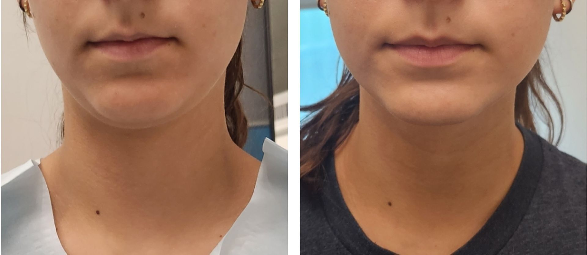 Monaco MedSpa Before and After Gallery, Real Clients, Real Results