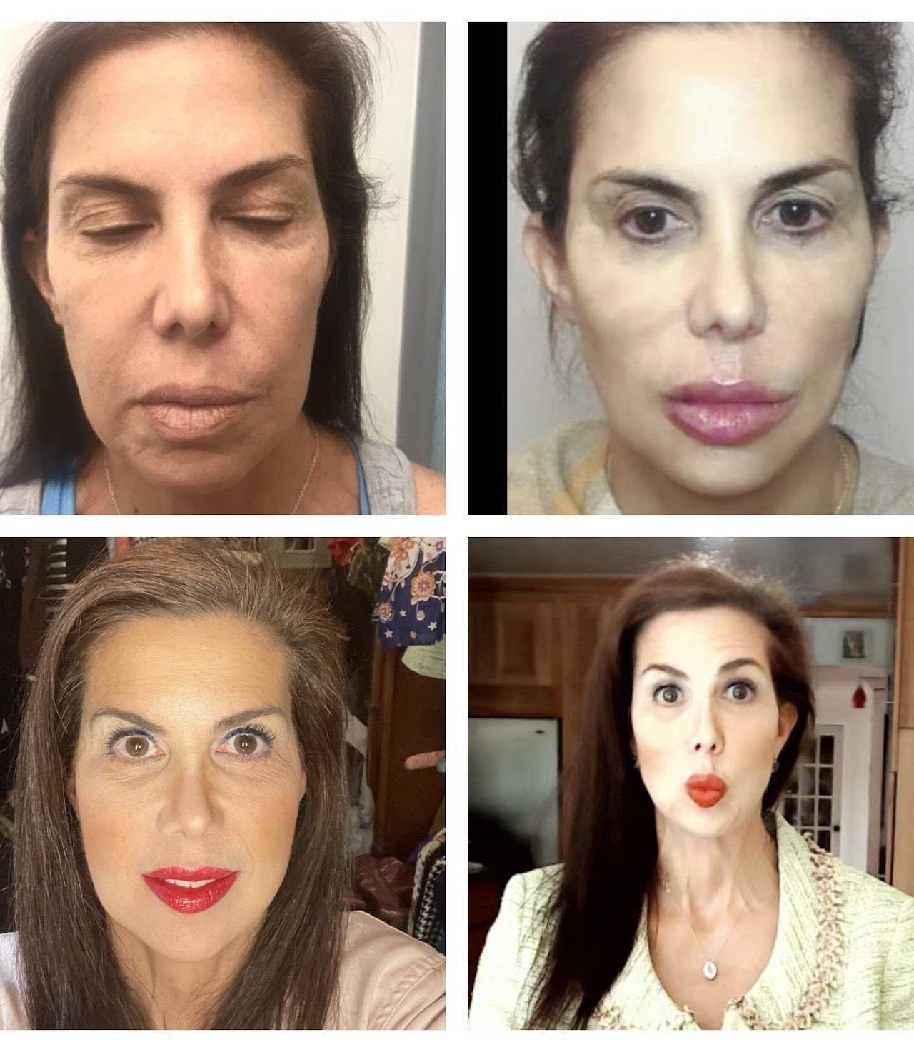 Monaco MedSpa Before and After Gallery, Real Clients, Real Results