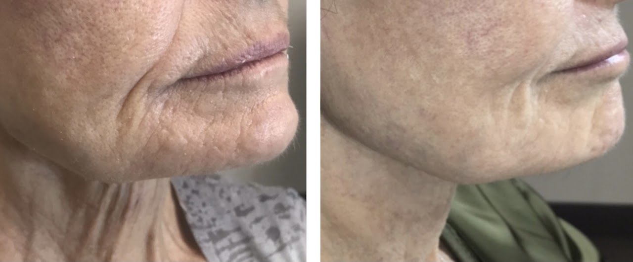 Monaco MedSpa Before and After Gallery, Real Clients, Real Results