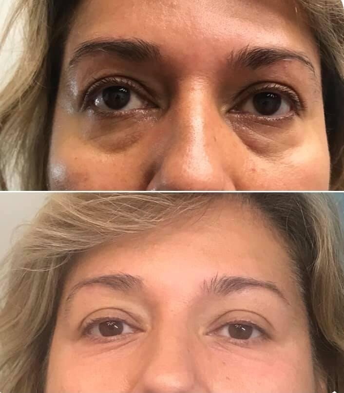 Plexr Plasma Pen Skin Tightening in Miami, FL