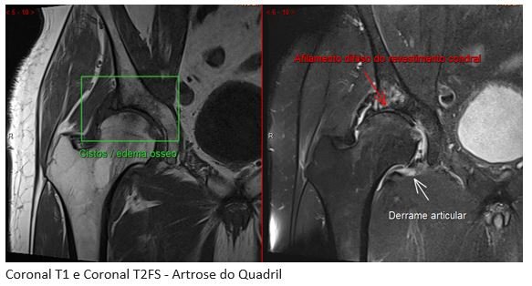 Ressonância magnética do quadril: saiba mais