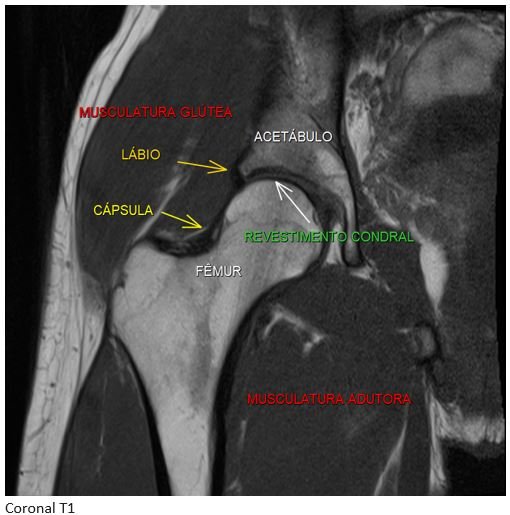 Ressonância magnética do quadril: saiba mais