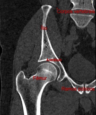 Tomografia do quadril: como é feita e para que serve?