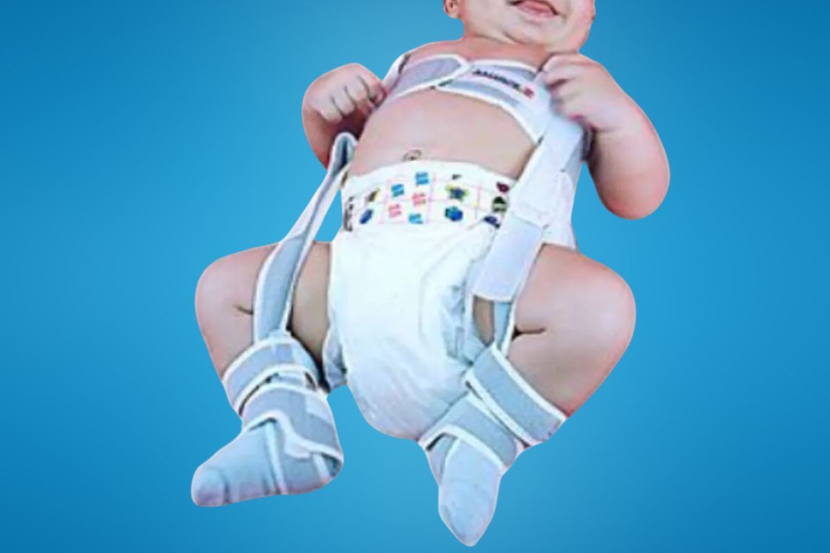 Luxação congênita de quadril: como reconhecer e tratar nos primeiros ...