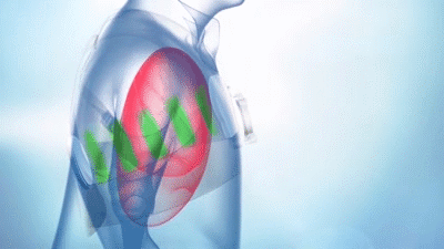 No More Heart Attack | Medical Engineers