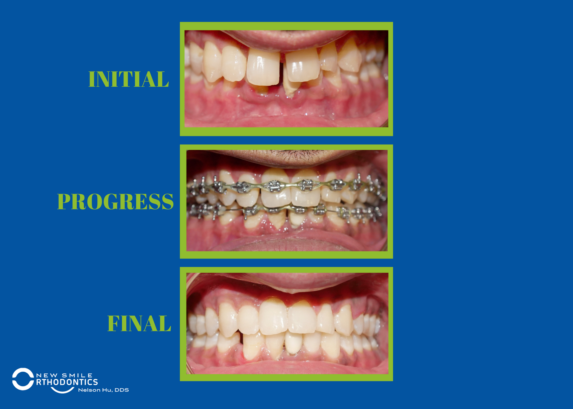 Traditional and Ceramic Braces in Tracy and Manteca, CA