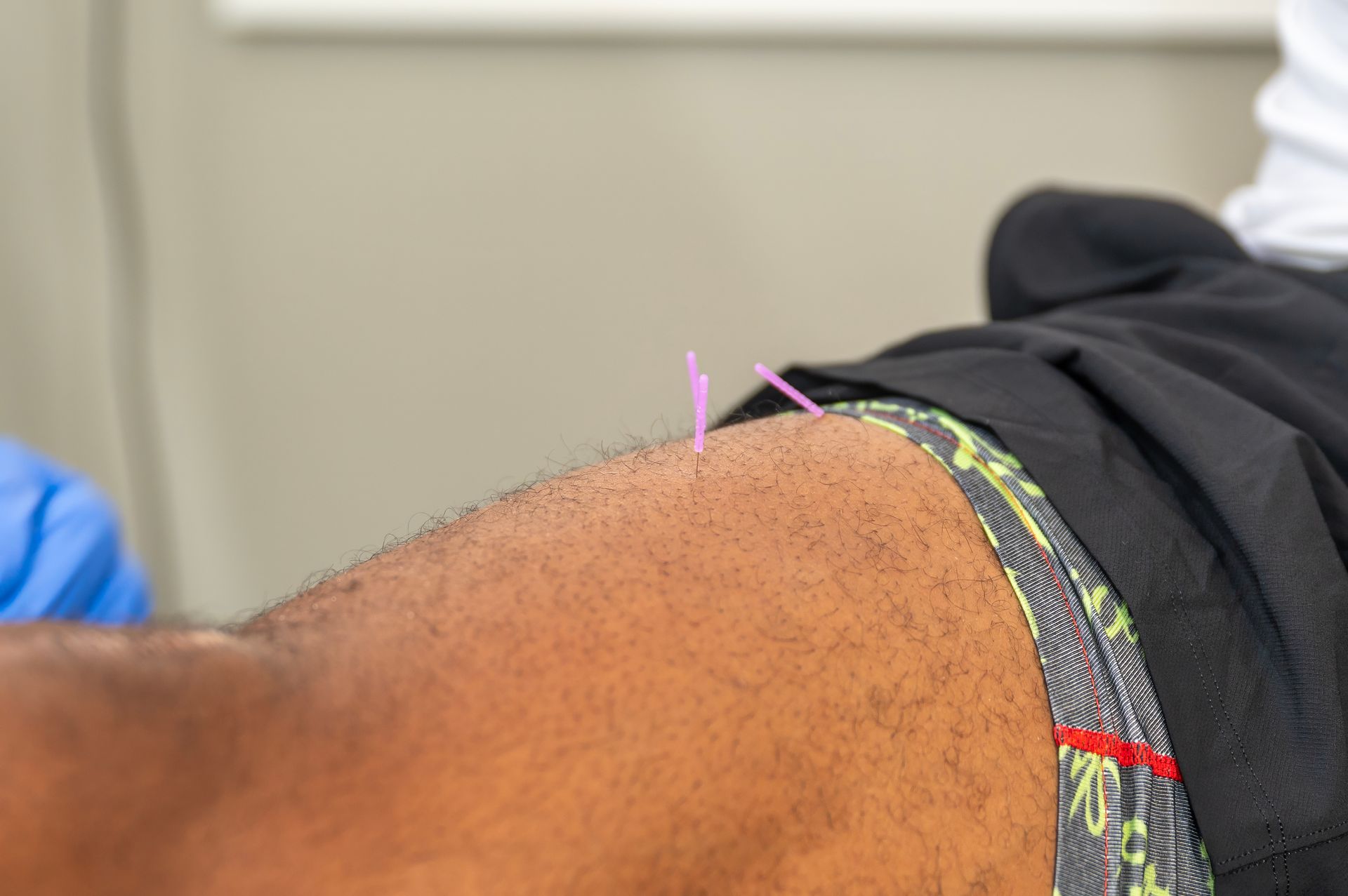 Fayetteville GA Dry Needling Services | Muscle Pain Treatment