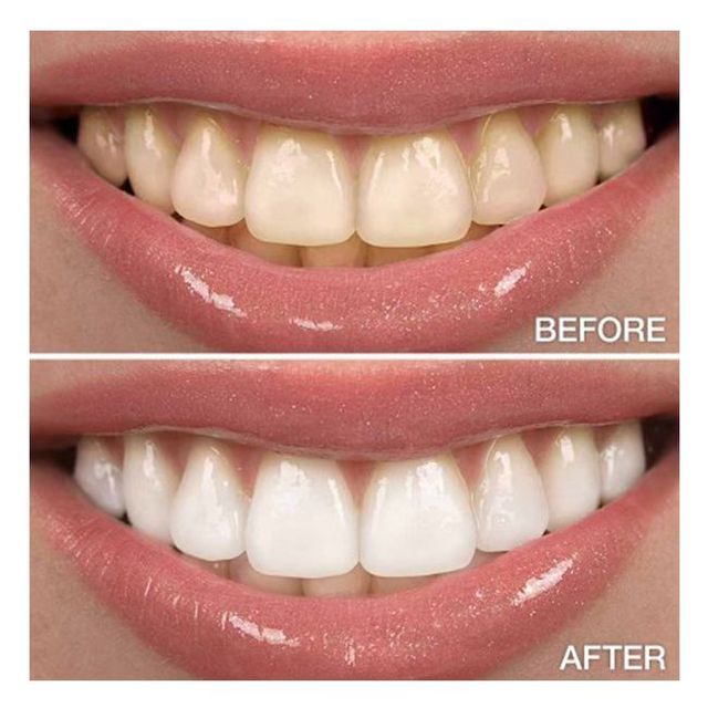 Gum Recession Treatment - Steliotes Dental Spa