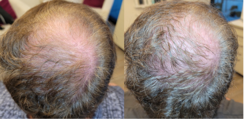 TED Hair Restoration