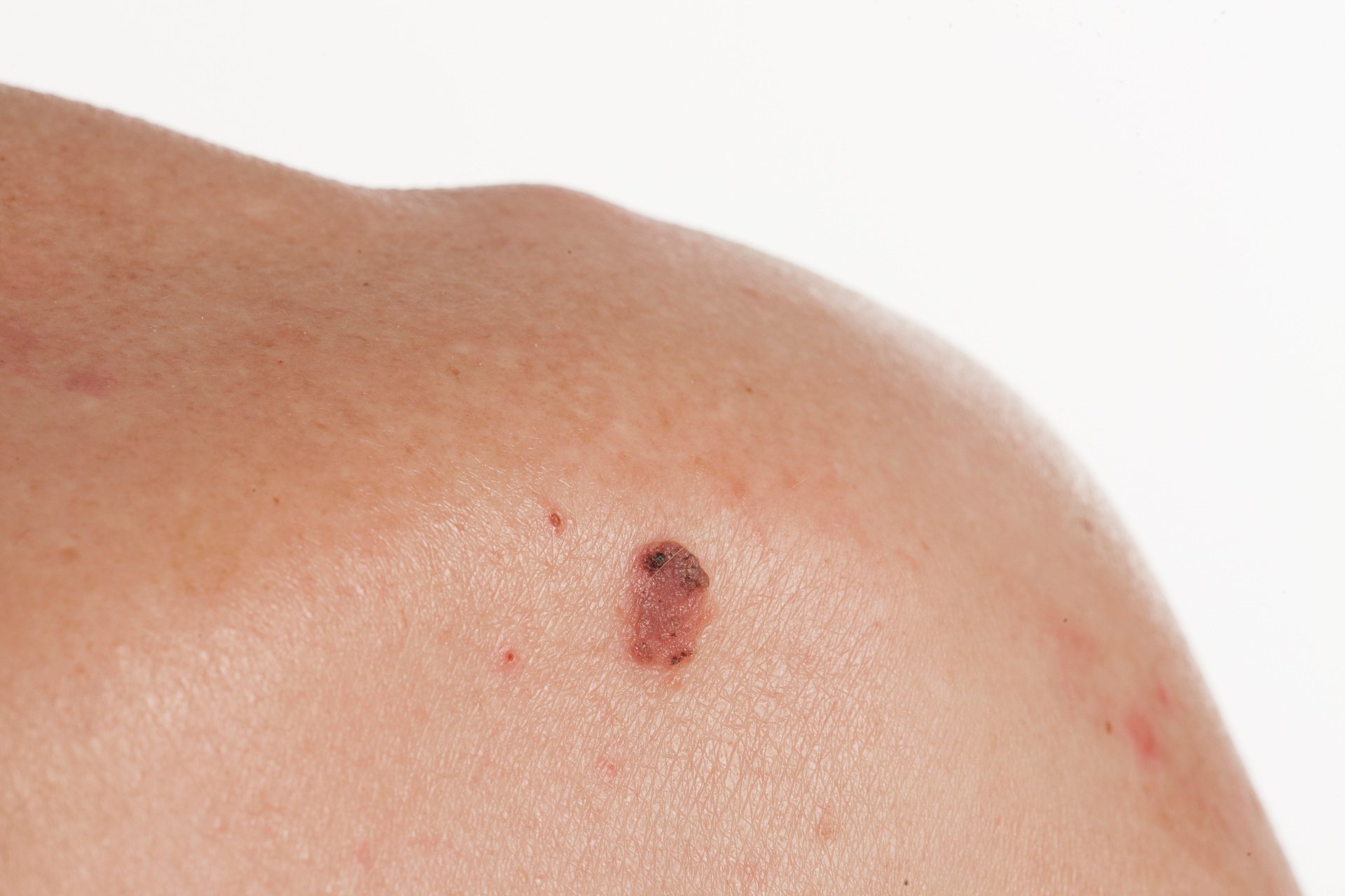 Skin Cancer Care | Dermatology Associates of Oak Ridge, P.C.