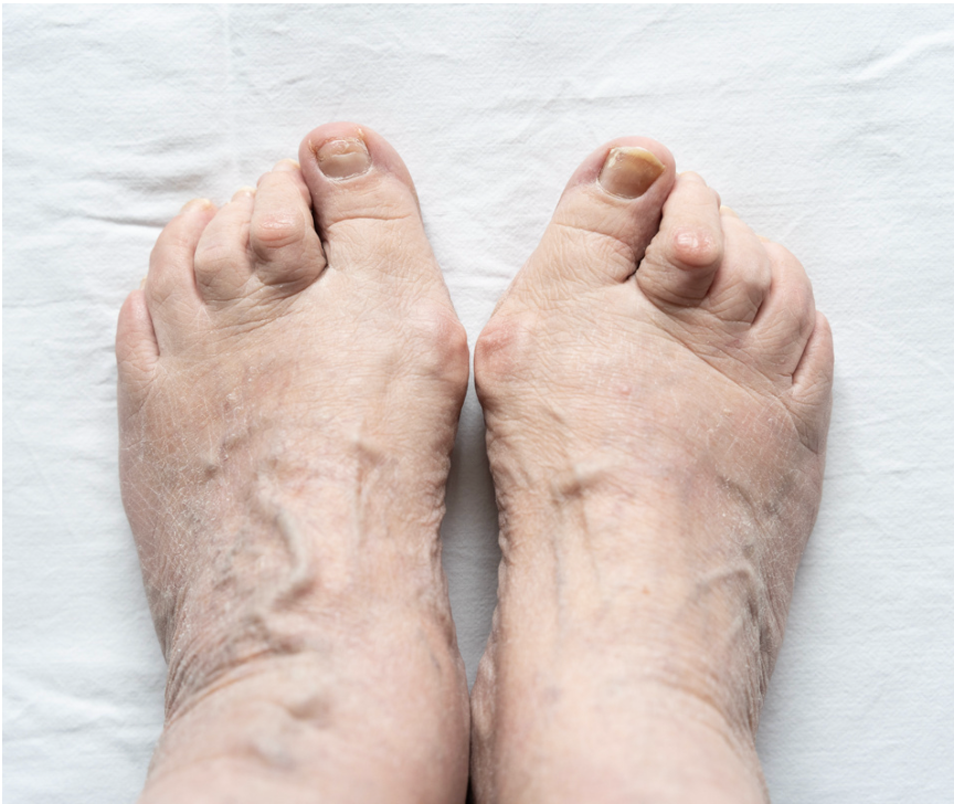 Lesser Toe Deformities | Dr Christy Graff, Adelaide, SA