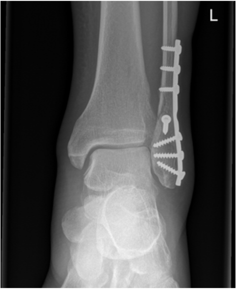 Lesser Toe Correction Surgery | Dr Graff | Adelaide